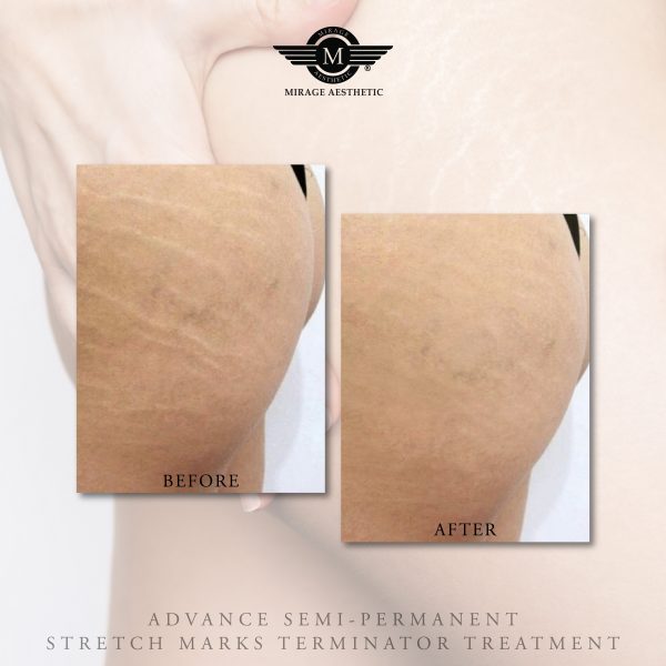 Stretch Mark Camouflage Course in Singapore